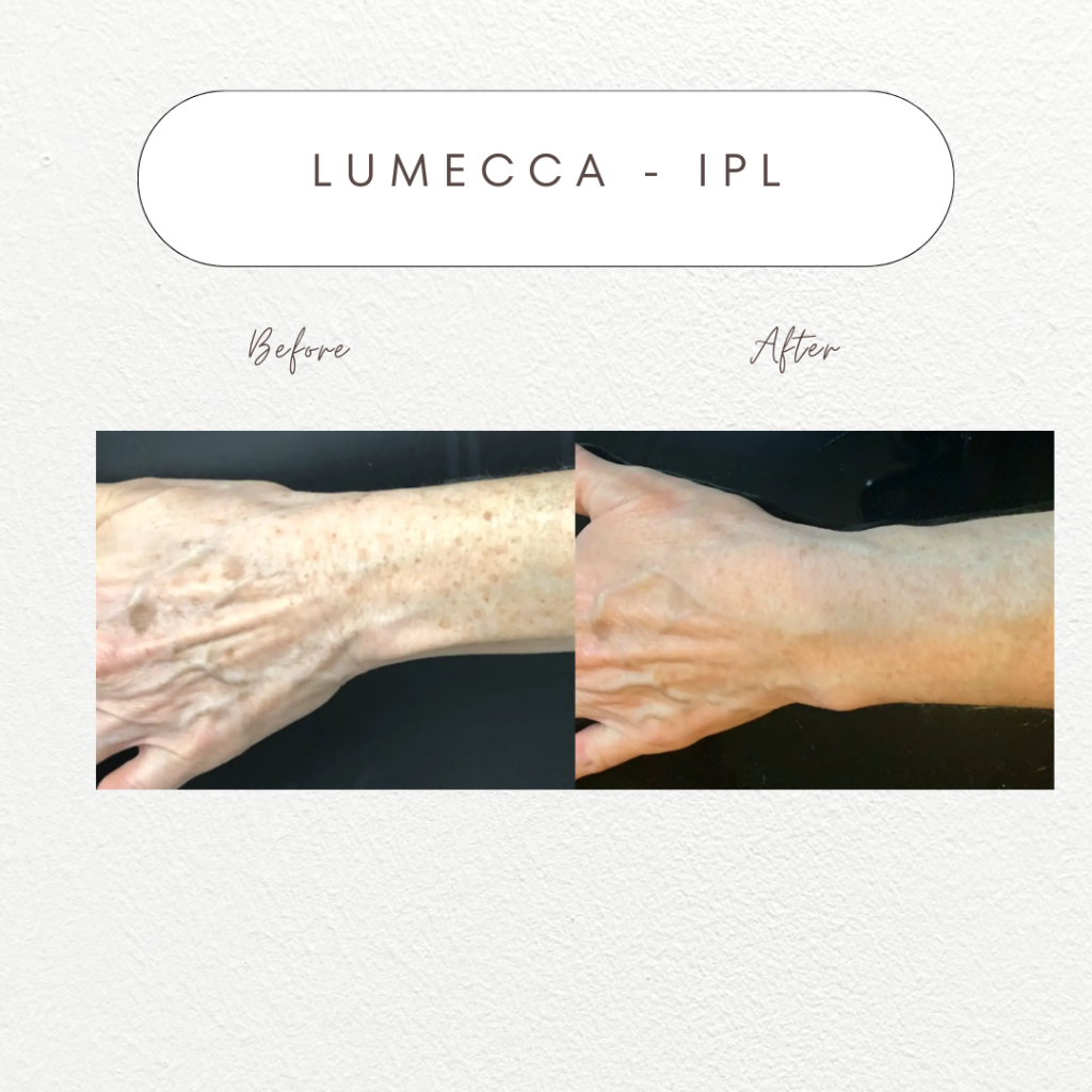 Lumecca (IPL) - Clear Skin - Aspire Care Clinic IPL Photofacial Airdrie ...